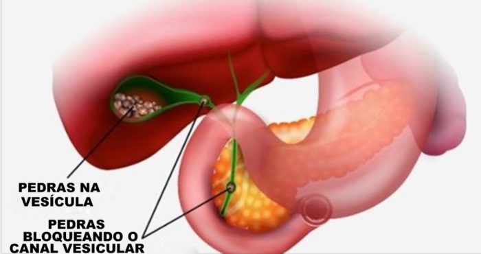 8 Sintomas que podem alertar sobre um problema de vesícula biliar ...